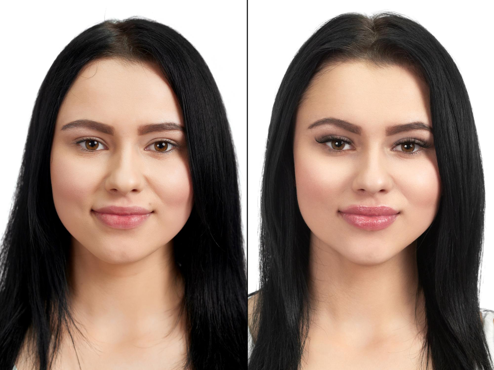 Chin Filler Before and After: 10 Stunning Transformations You Need to ...
